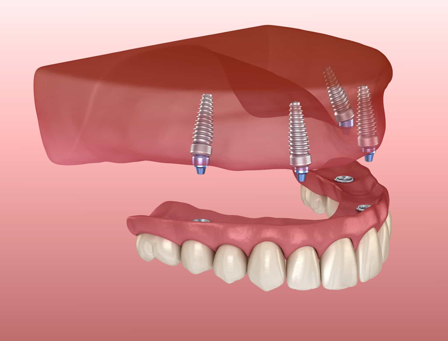Snap-On Dentures - Billings Oral Surgery & Dental Implant Center
