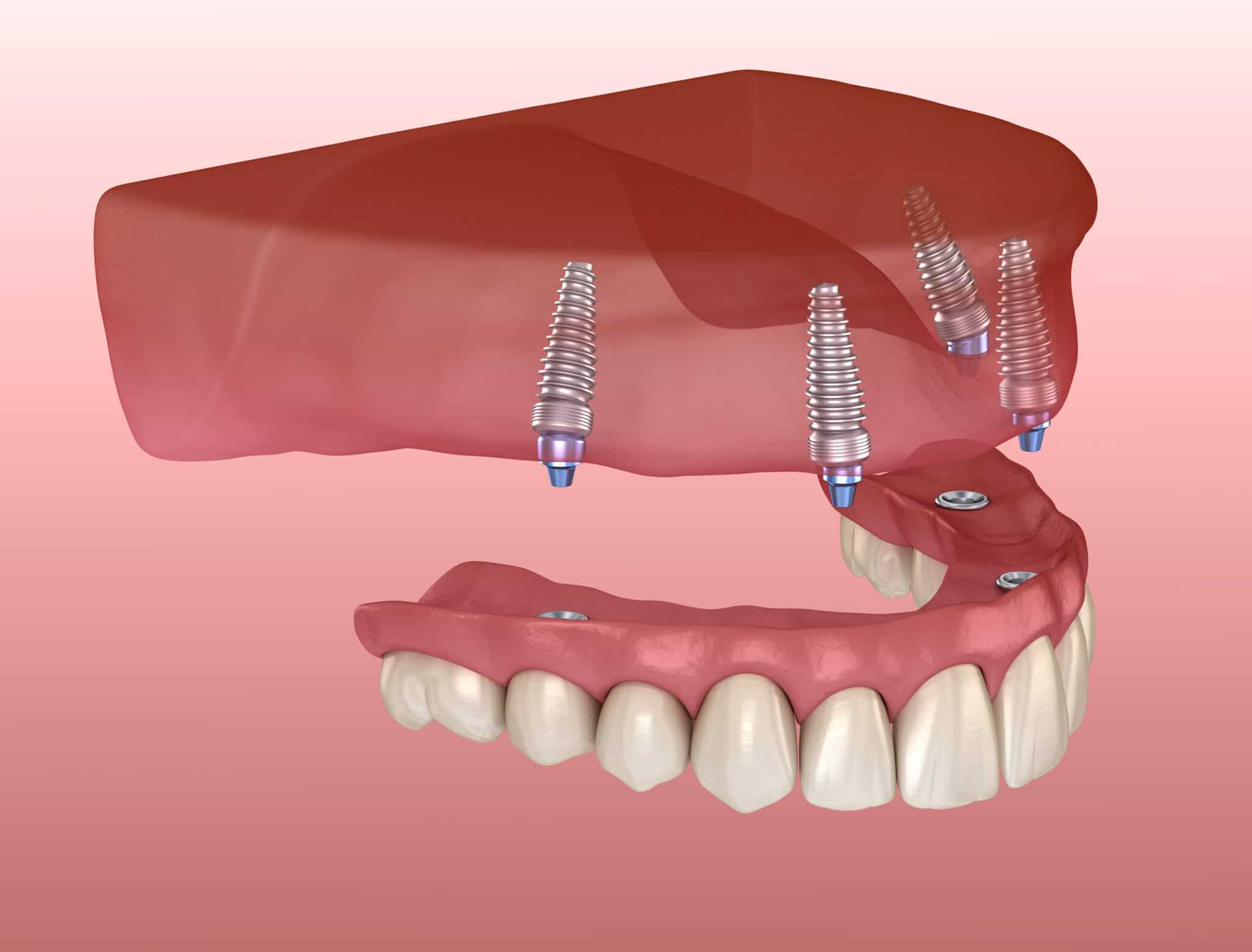 Snap-On Dentures - Billings Oral Surgery & Dental Implant Center