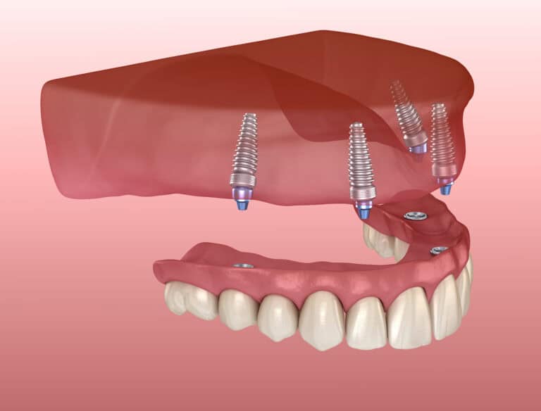 Snap-On Dentures - Billings Oral Surgery & Dental Implant Center
