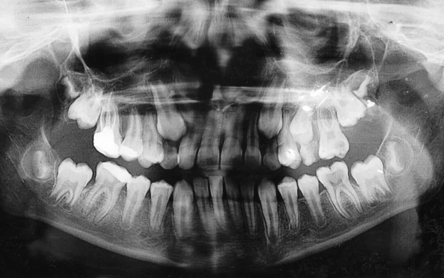 Impacted Canines - Billings Oral Surgery & Dental Implant Center