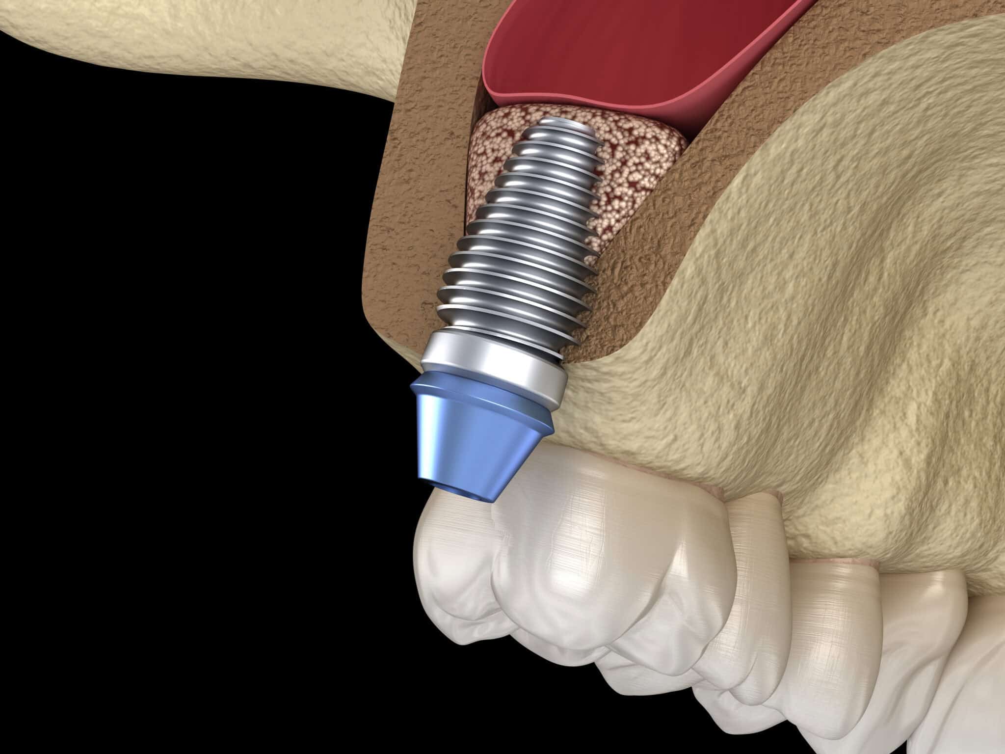 Sinus Lift - Billings Oral Surgery & Dental Implant Center