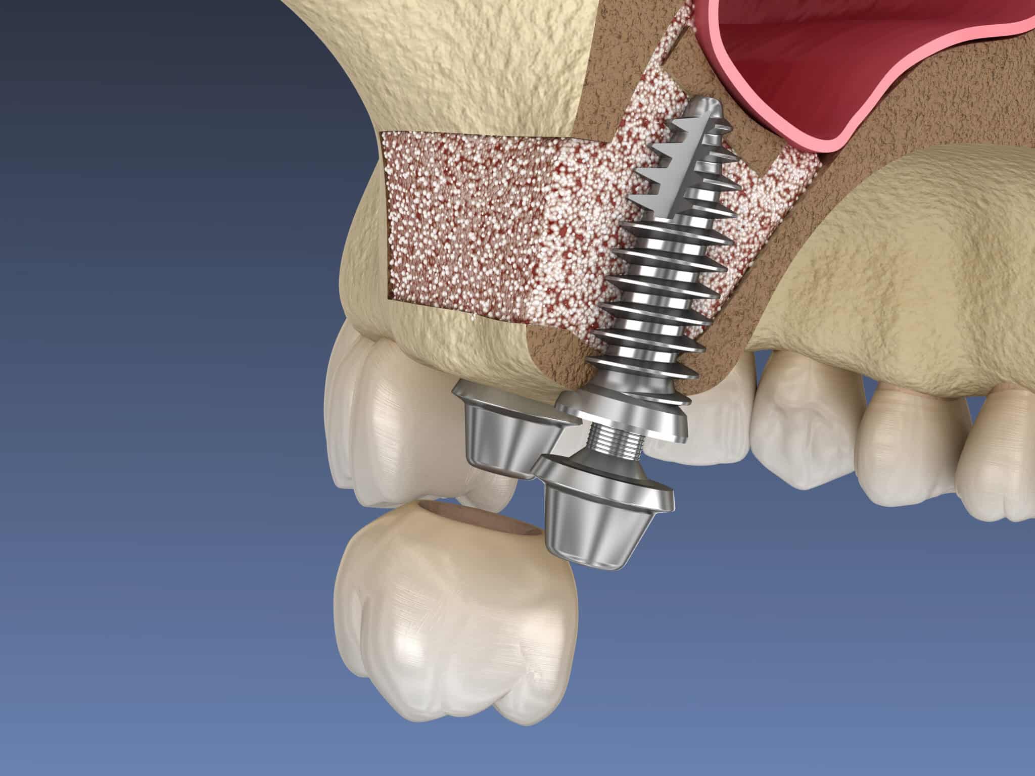 Sinus Lift - Billings Oral Surgery & Dental Implant Center